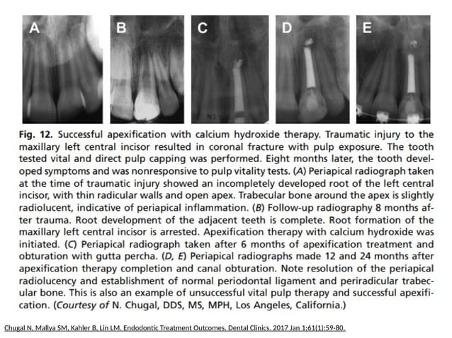 ENDODONTIC TREATMENT OUTCOMES-root canal therapy | PPTX