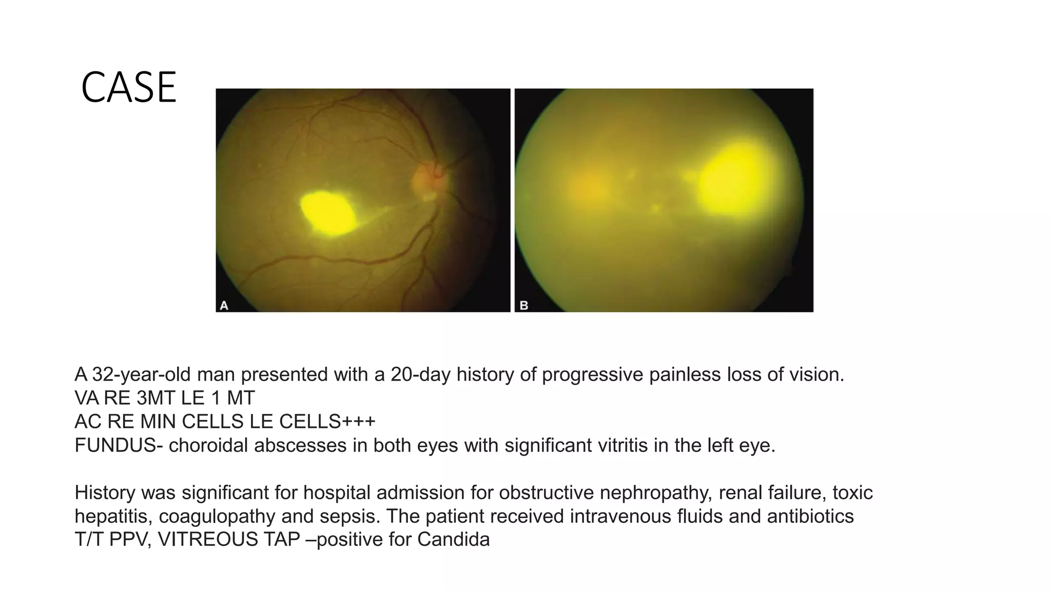 Endogenous fungal infections of eye | PPTX