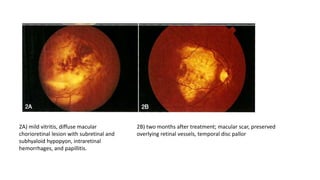 Endogenous fungal infections of eye | PPT