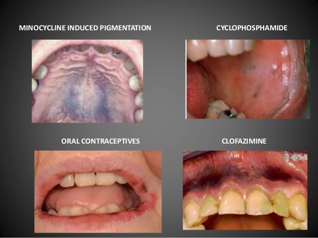 Endogenous pigmentation