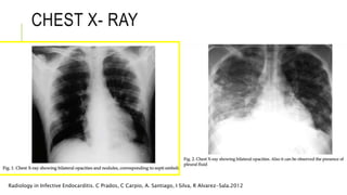 endokarditis infective ngaji pramita.pptx