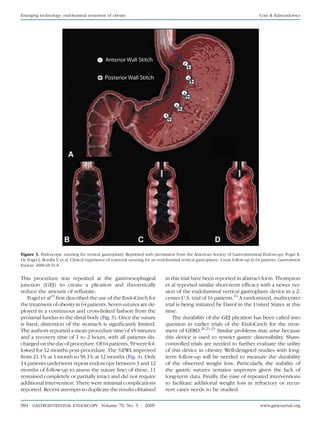 Primary endoluminal bariatric surgery | PDF