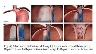 Endoluminal therapy in GERD | PPTX
