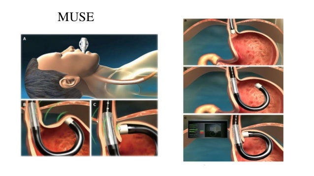 Endoluminal therapy in GERD