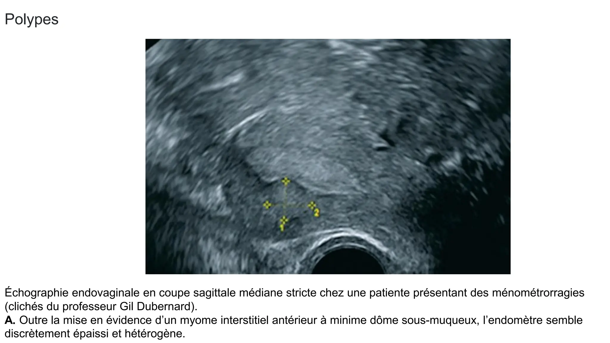 ENDOMETRE cours d'anatomie en gynécologie obstétrique | PPT ENDOMETRE cours d'anatomie en gynécologie obstétrique | PPT