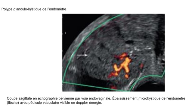 ENDOMETRE cours d'anatomie en gynécologie obstétrique | PPT ENDOMETRE cours d'anatomie en gynécologie obstétrique | PPT