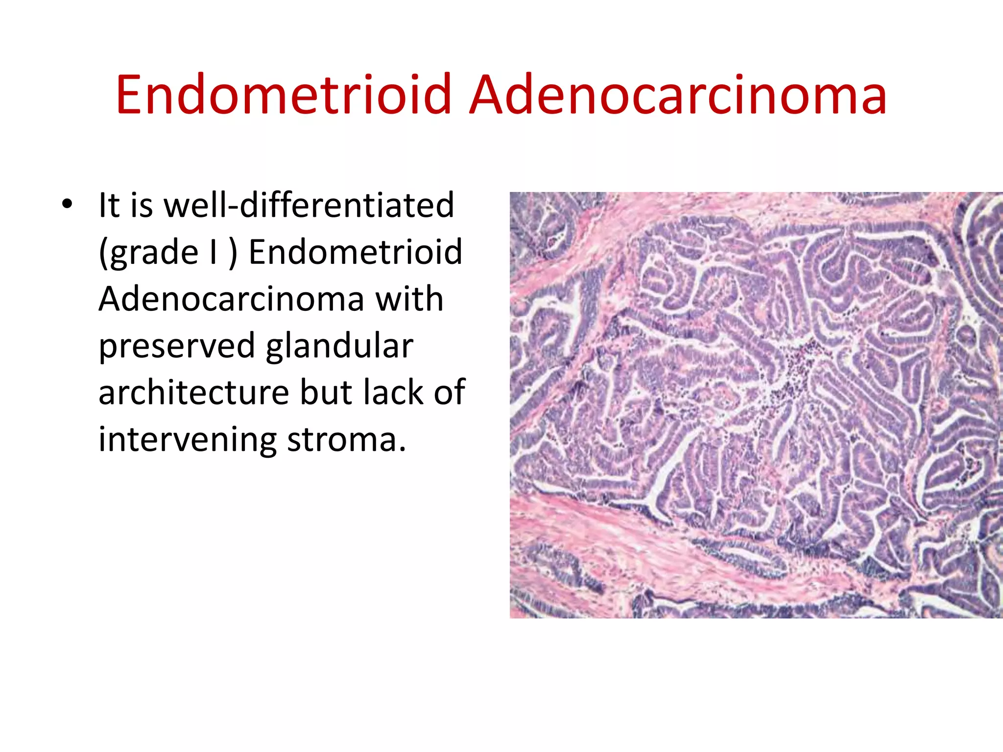 endometria ca.pptx