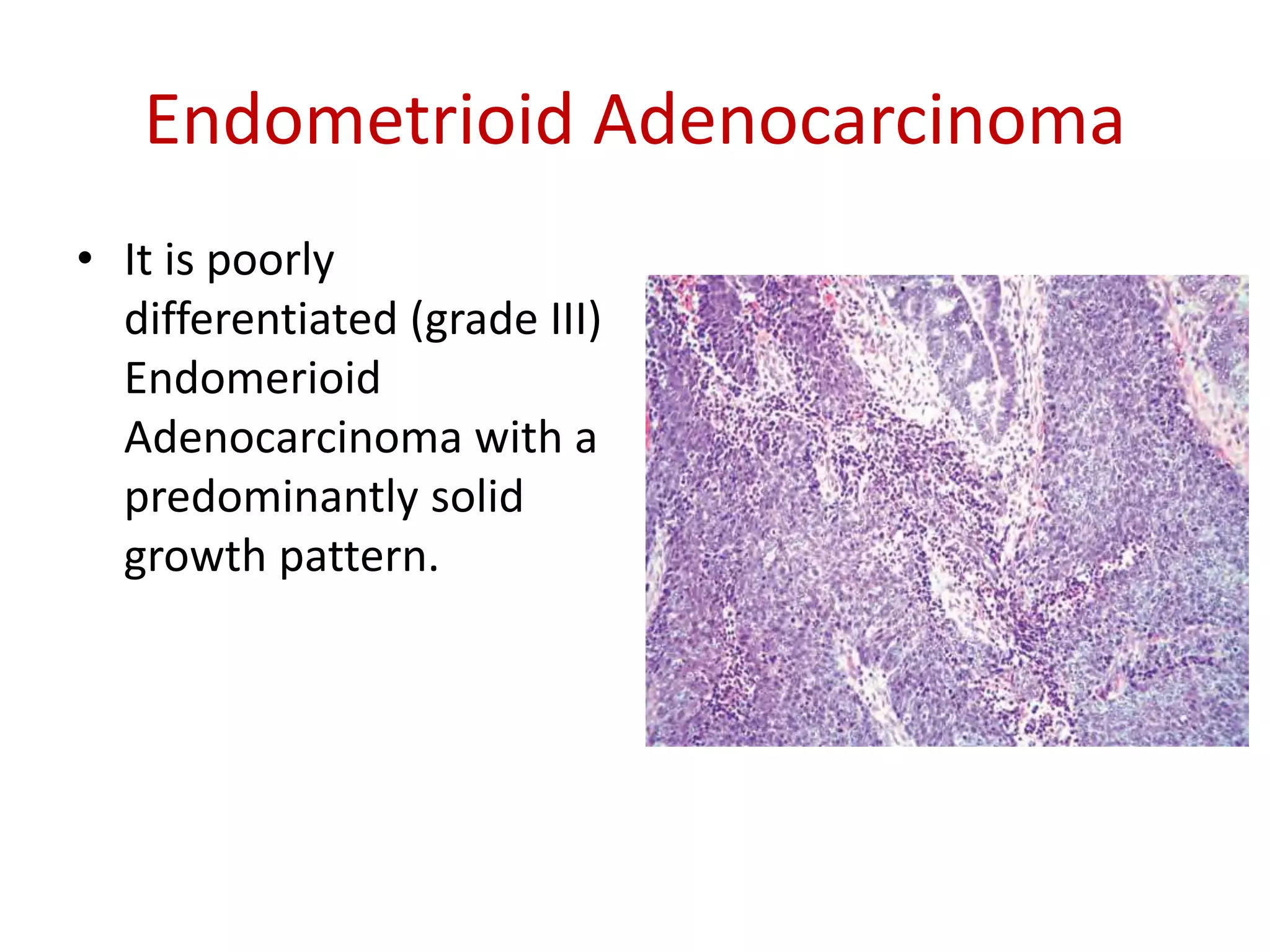 endometria ca.pptx