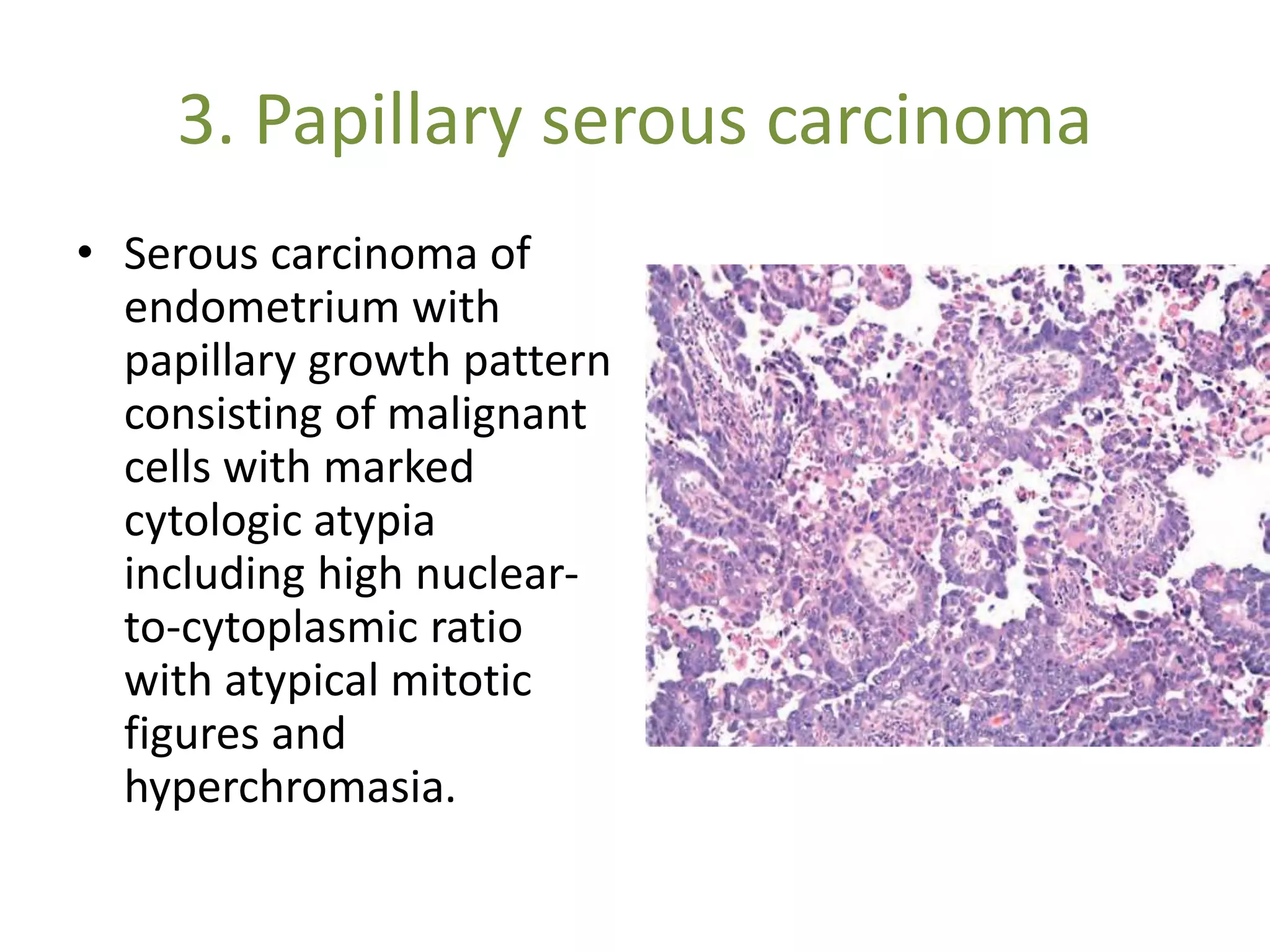 endometria ca.pptx