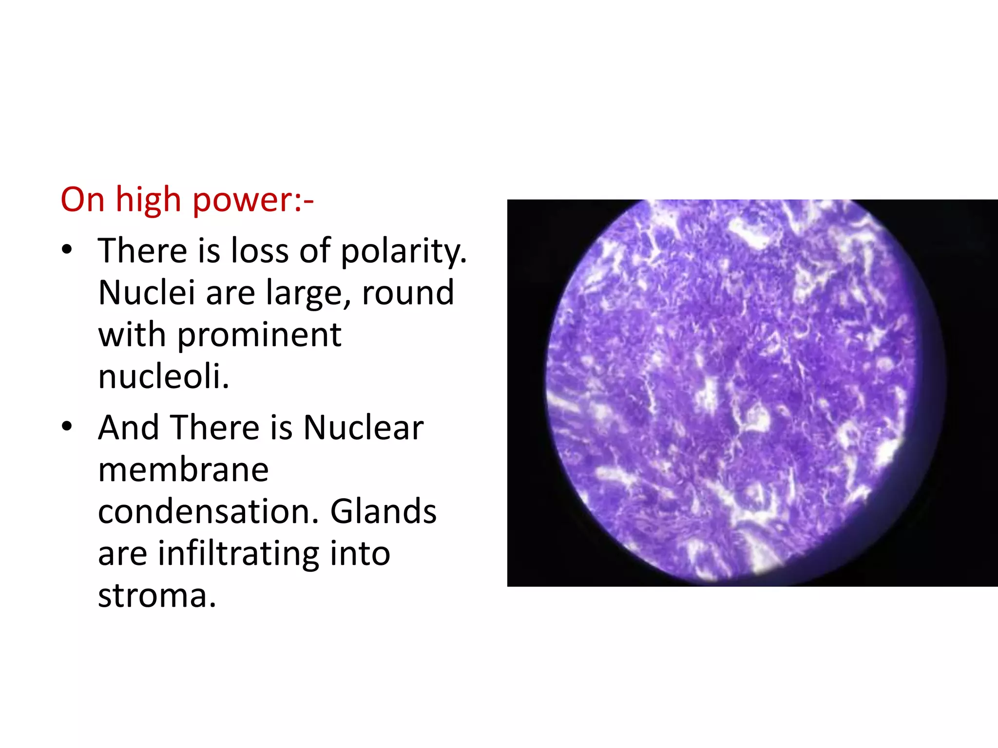 endometria ca.pptx