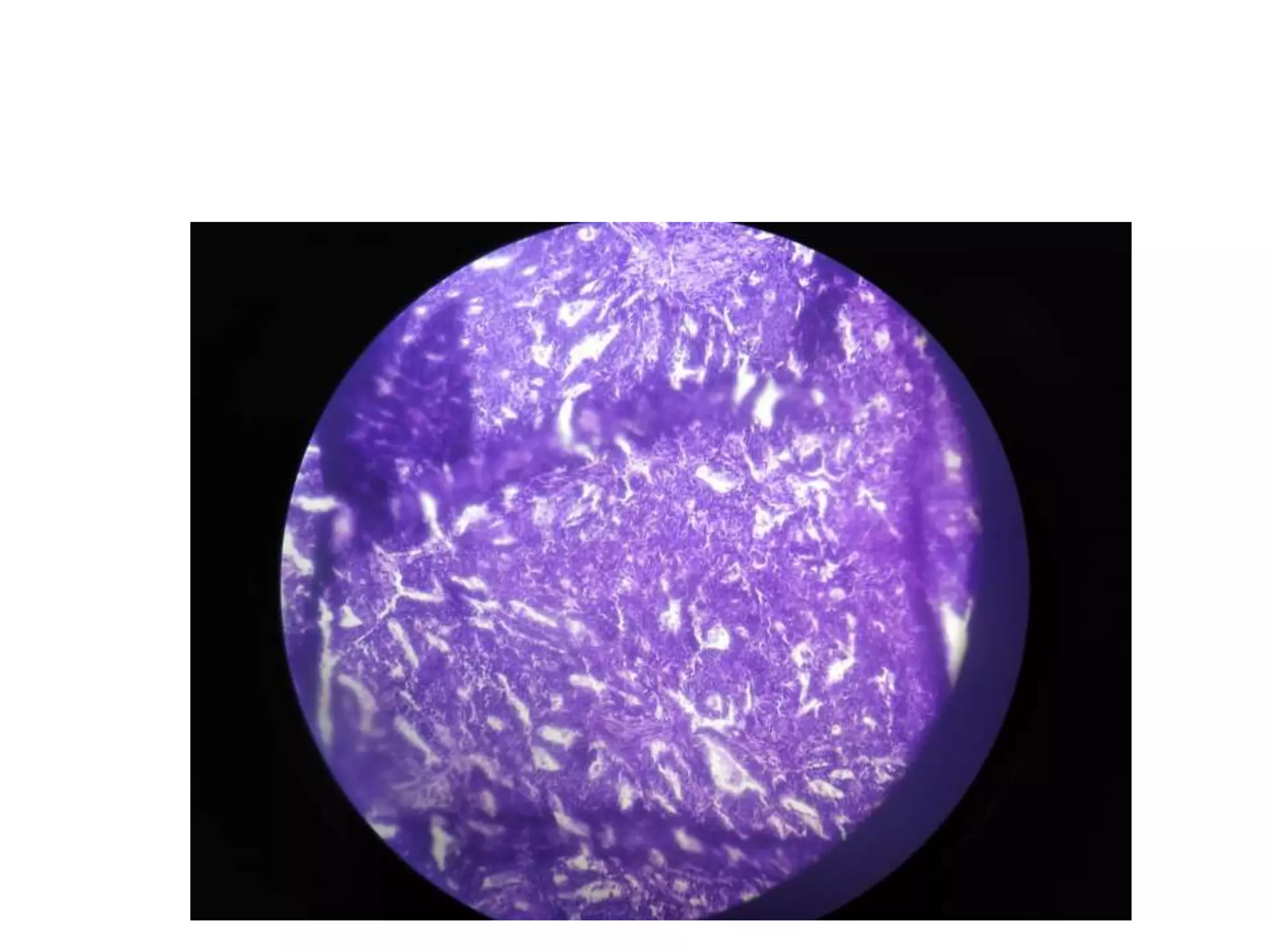 endometria ca.pptx