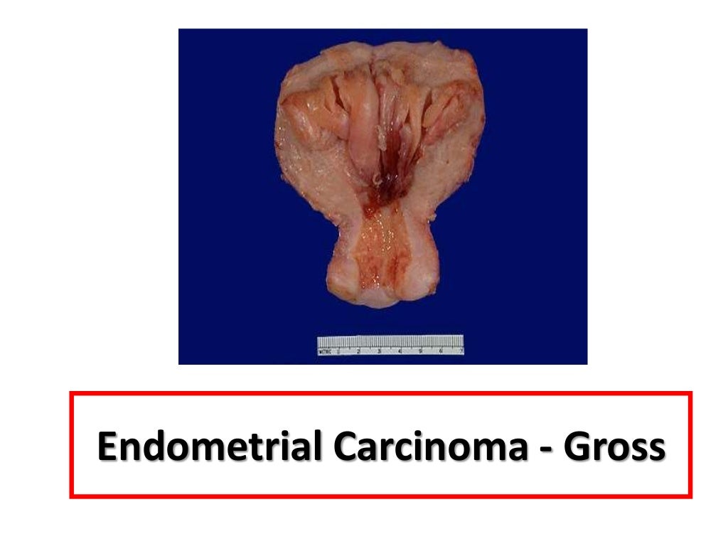 Endometrial Carcinoma