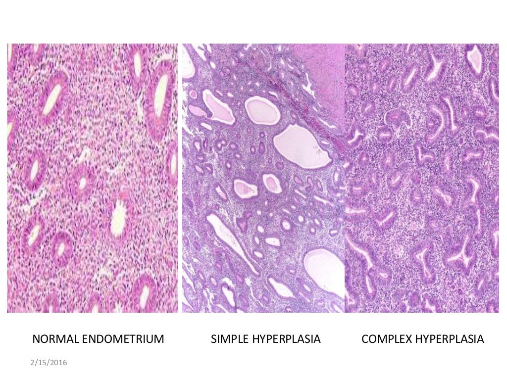 Endometrial hyperplasia