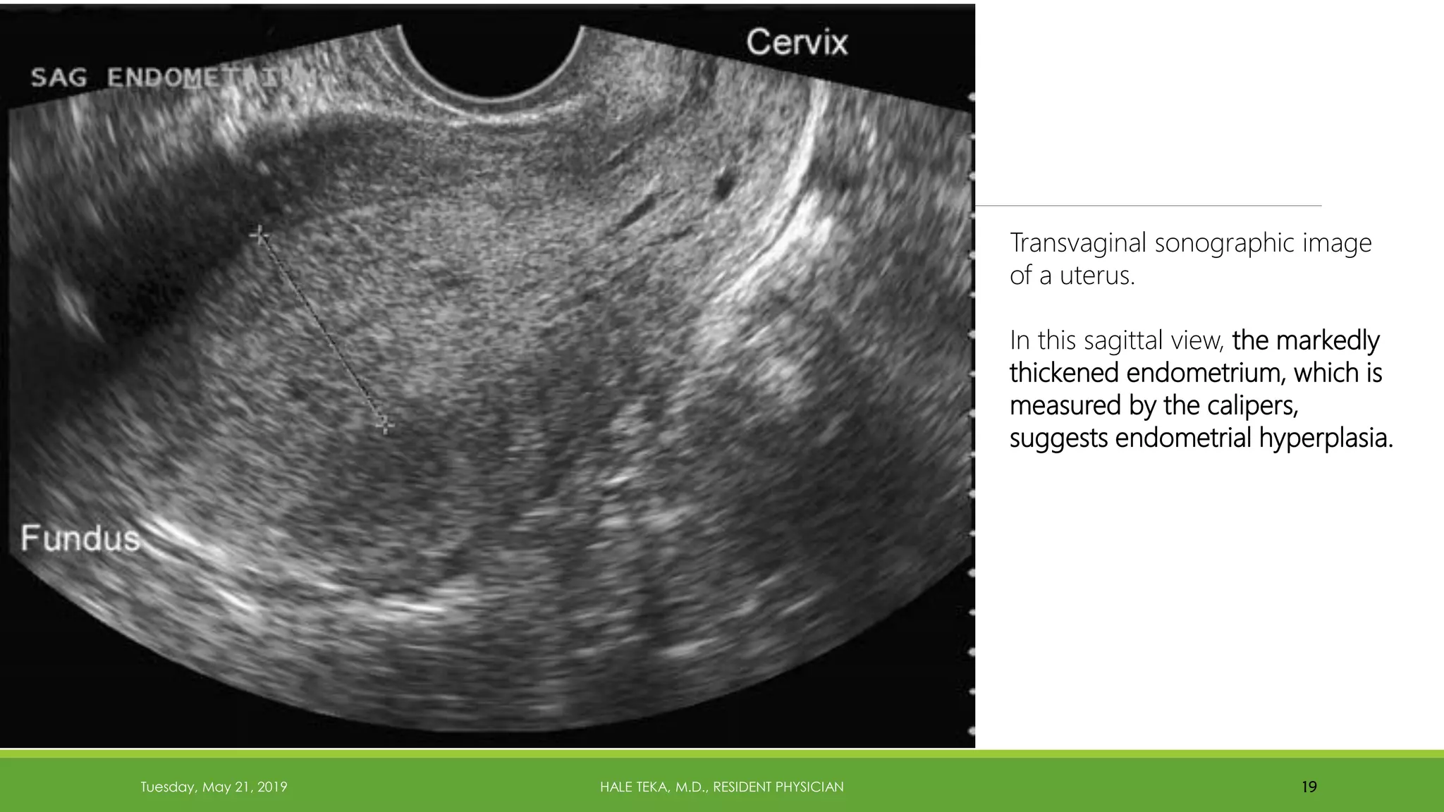 Endometrial ca (hyperplasia and invasive ca) | PDF