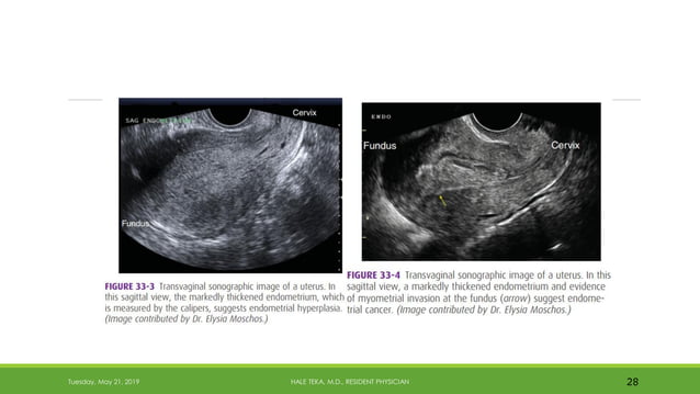Endometrial ca (hyperplasia and invasive ca) | PPT