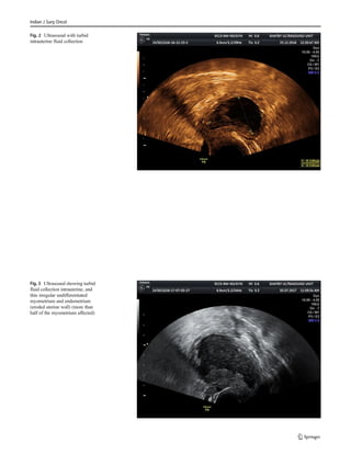Endometrial cancer | PDF