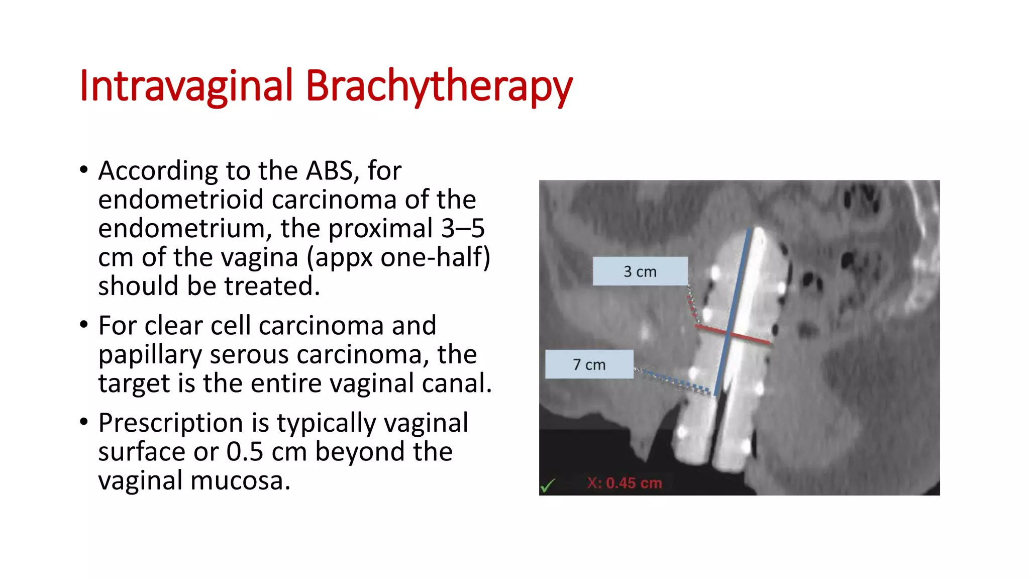 Case Study: Endometrial Cancer | PPTX