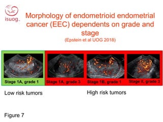 Endometrial cancer | PPTX