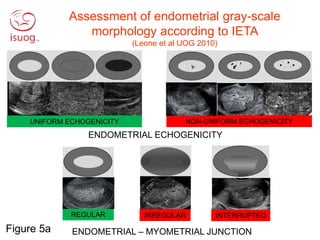 Endometrial cancer | PPTX