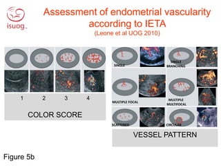 Endometrial cancer | PPTX