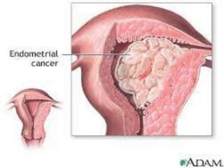 endometrial cancer #.ppt....................... | PPT