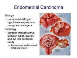 endometrial cancer #.ppt....................... | PPT
