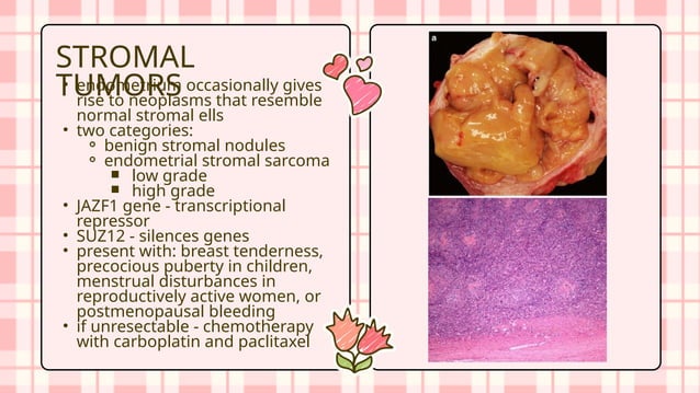 Endometrial Cancer Presentation + Tumors of Endometrial Stroma | PPT