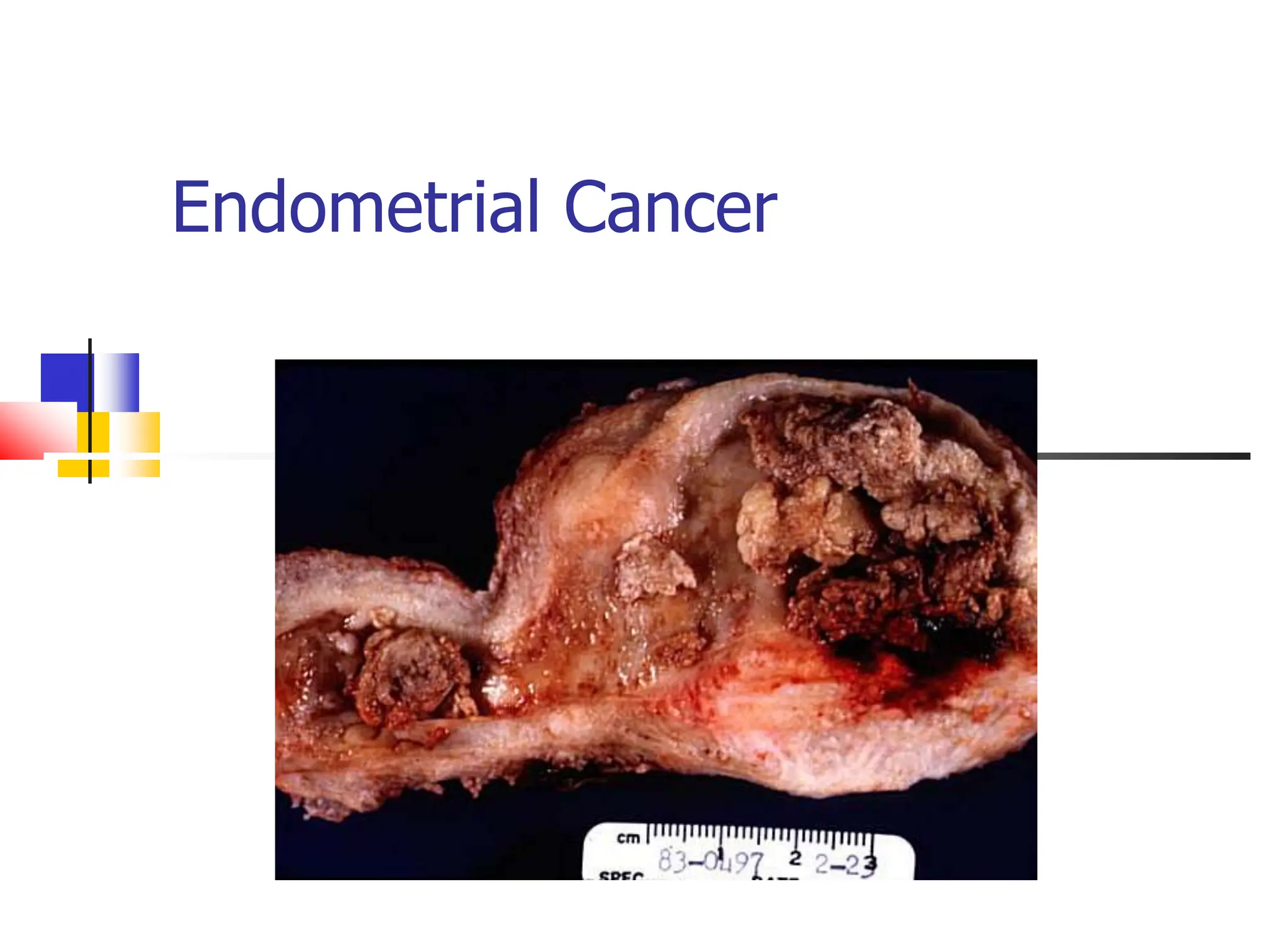 WORK UP A CASE OF Endometrial cancer .ppt | Menopause | Endocrine and Metabolic Diseases
