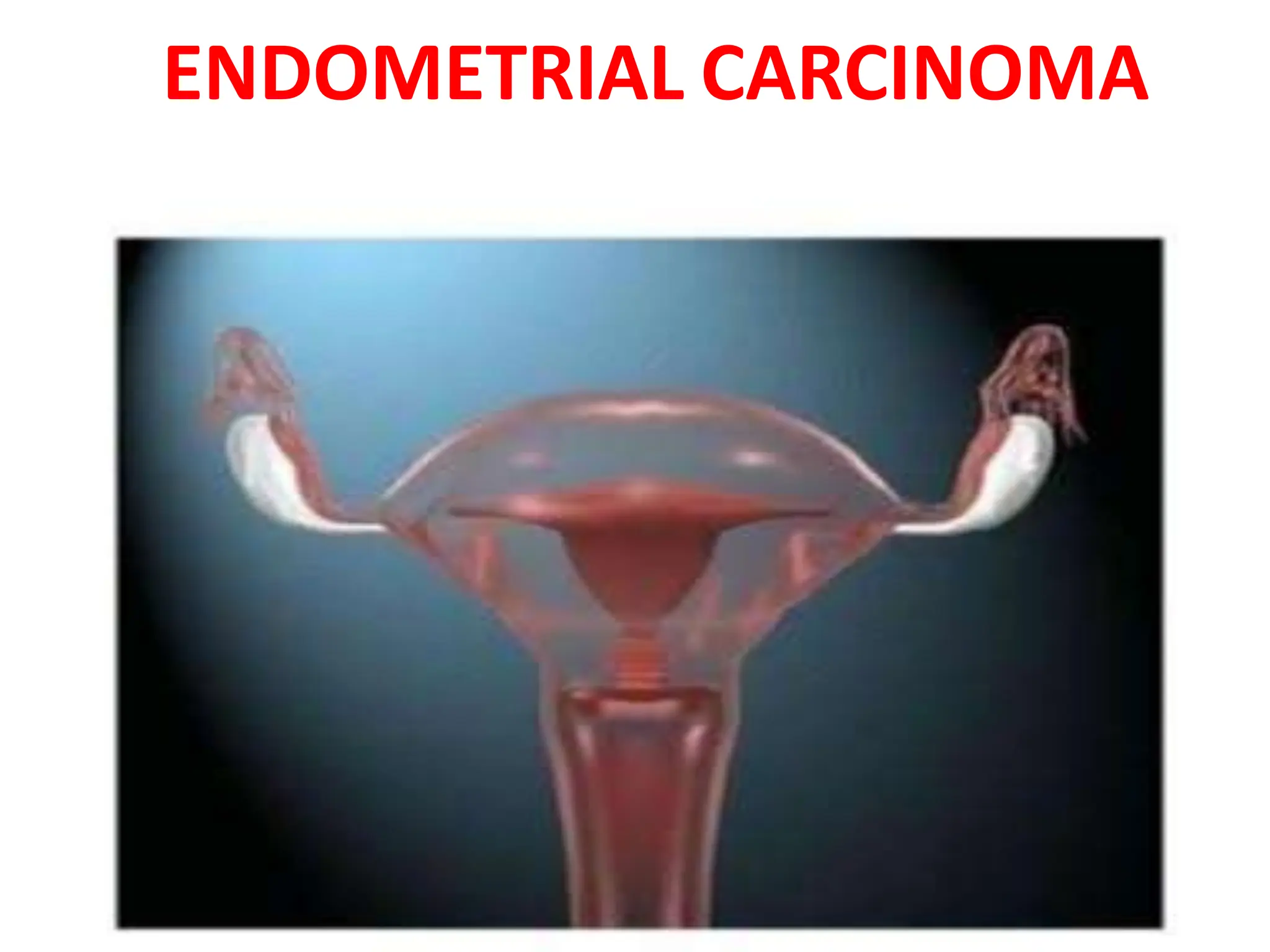 WORK UP A CASE OF Endometrial cancer .ppt | Menopause | Endocrine and Metabolic Diseases