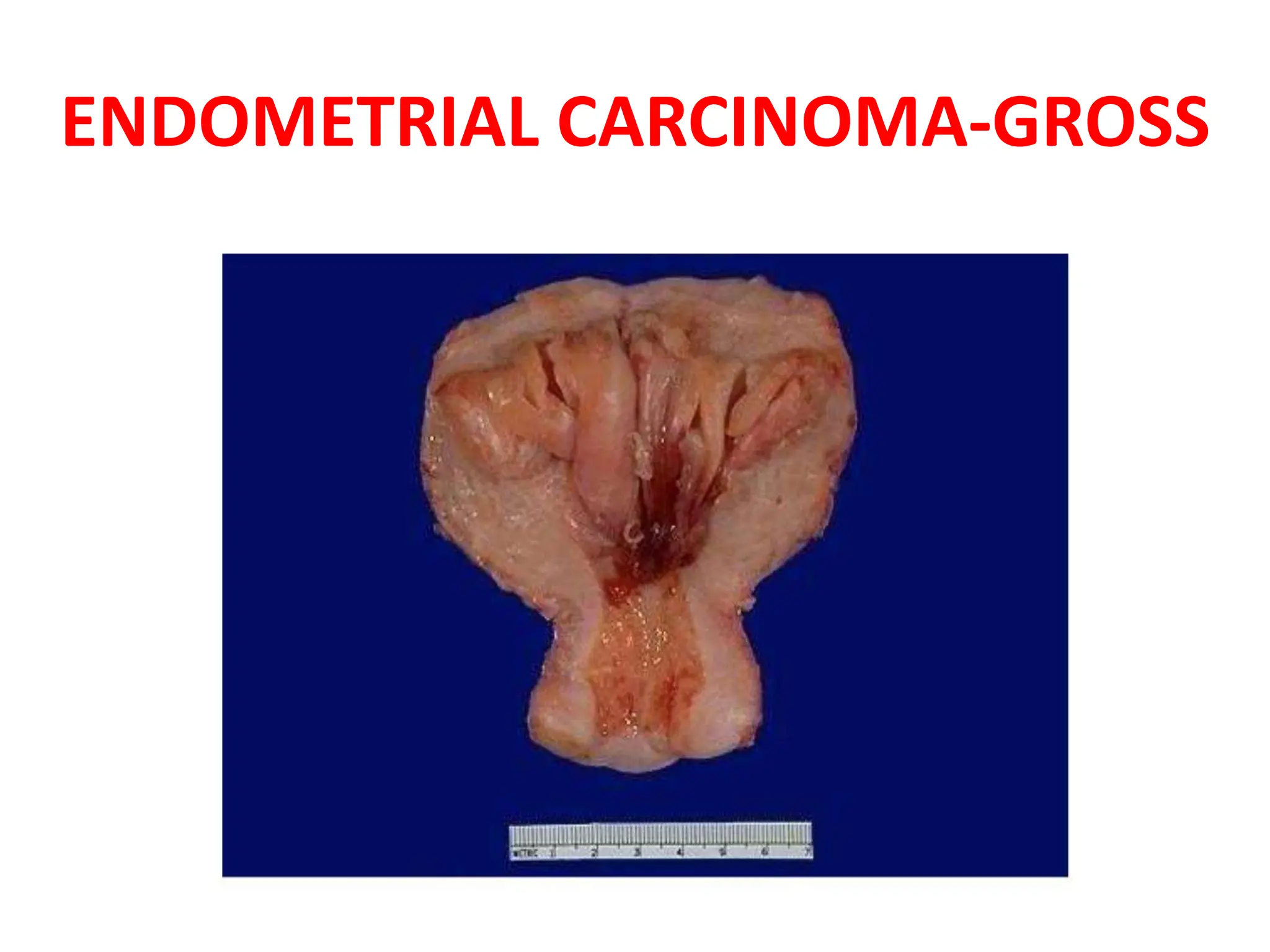 WORK UP A CASE OF Endometrial cancer .ppt