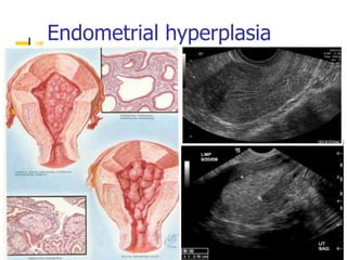 WORK UP A CASE OF Endometrial cancer .ppt
