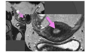 ENDOMETRIAL CARCINOMA: Role of MRI in evaluation | PPT