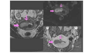 ENDOMETRIAL CARCINOMA: Role of MRI in evaluation | PPT