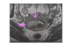 ENDOMETRIAL CARCINOMA: Role of MRI in evaluation | PPT
