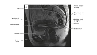 ENDOMETRIAL CARCINOMA: Role of MRI in evaluation | PPTX
