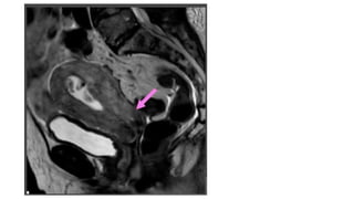 ENDOMETRIAL CARCINOMA: Role of MRI in evaluation | PPT