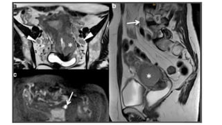 ENDOMETRIAL CARCINOMA: Role of MRI in evaluation | PPT