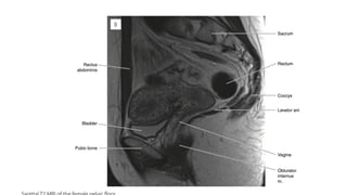 ENDOMETRIAL CARCINOMA: Role of MRI in evaluation | PPT