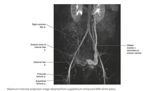 ENDOMETRIAL CARCINOMA: Role of MRI in evaluation | PPT