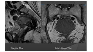ENDOMETRIAL CARCINOMA: Role of MRI in evaluation | PPT