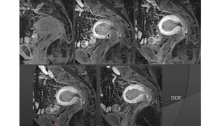 ENDOMETRIAL CARCINOMA: Role of MRI in evaluation | PPT