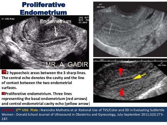 Endometrial cycle and infertility DR.RAHUL,PHYSIOLOGY,SMS MC JAIPUR e…