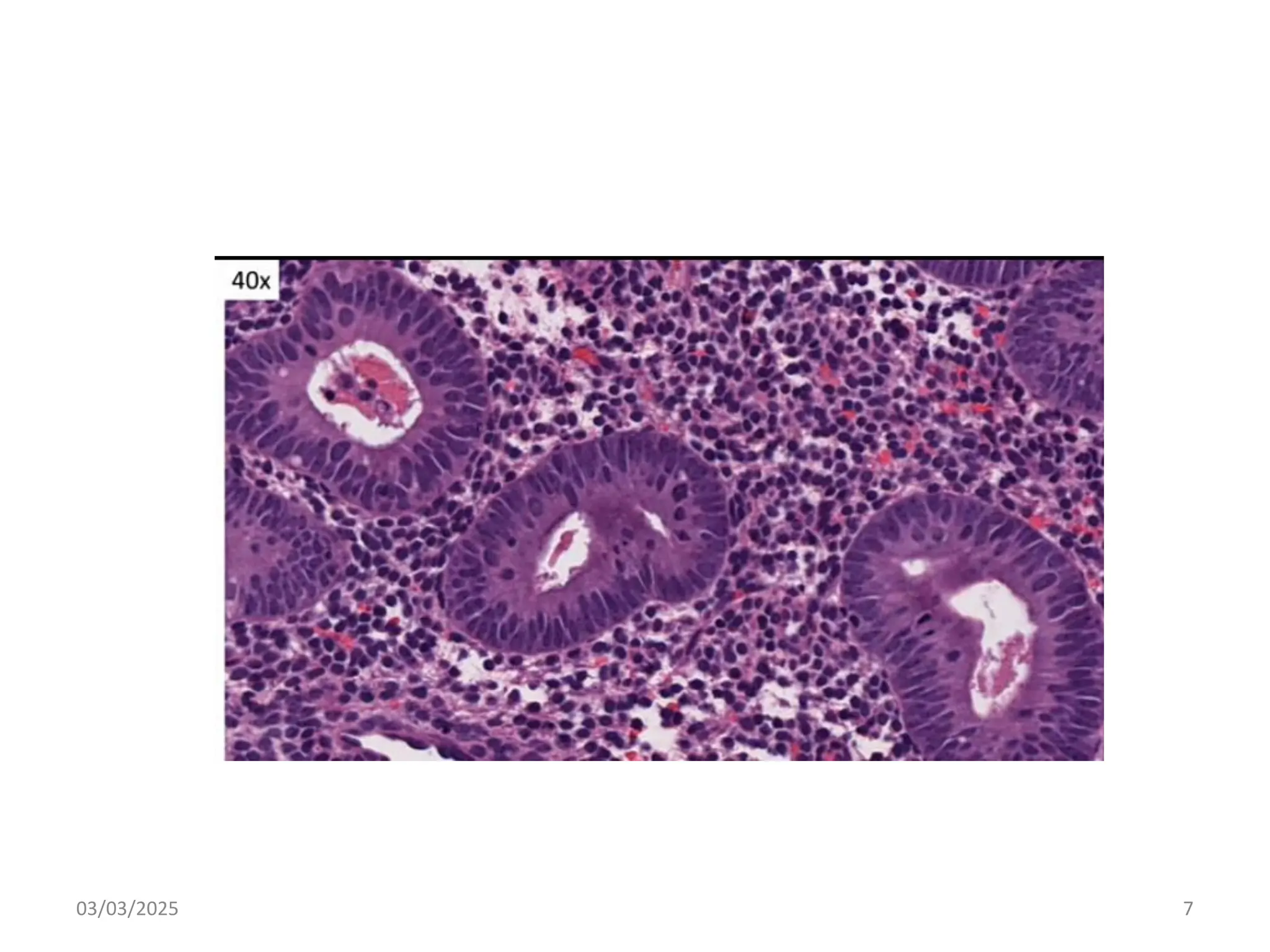Endometrial Histology: Normal findings, artefacts and metaplasia | PDF