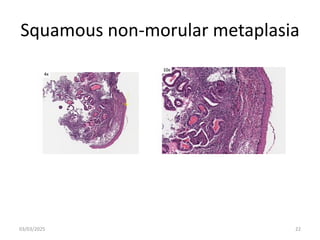 Endometrial Histology: Normal findings, artefacts and metaplasia | PDF
