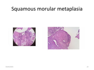 Endometrial Histology: Normal findings, artefacts and metaplasia | PDF
