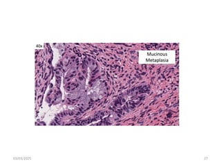 Endometrial Histology: Normal findings, artefacts and metaplasia | PDF