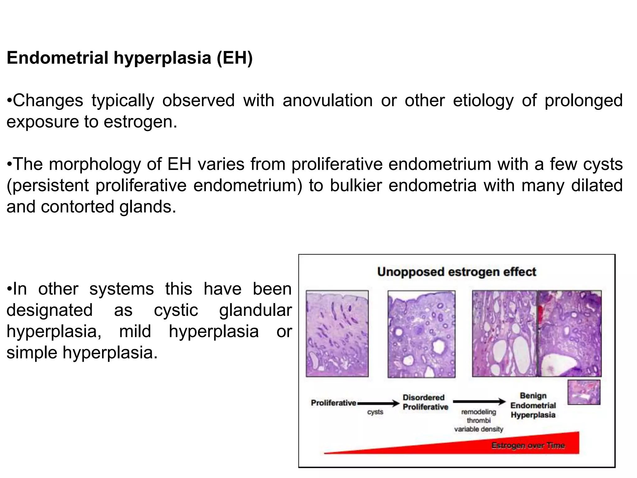 Endometrial hyperplasia | PPT