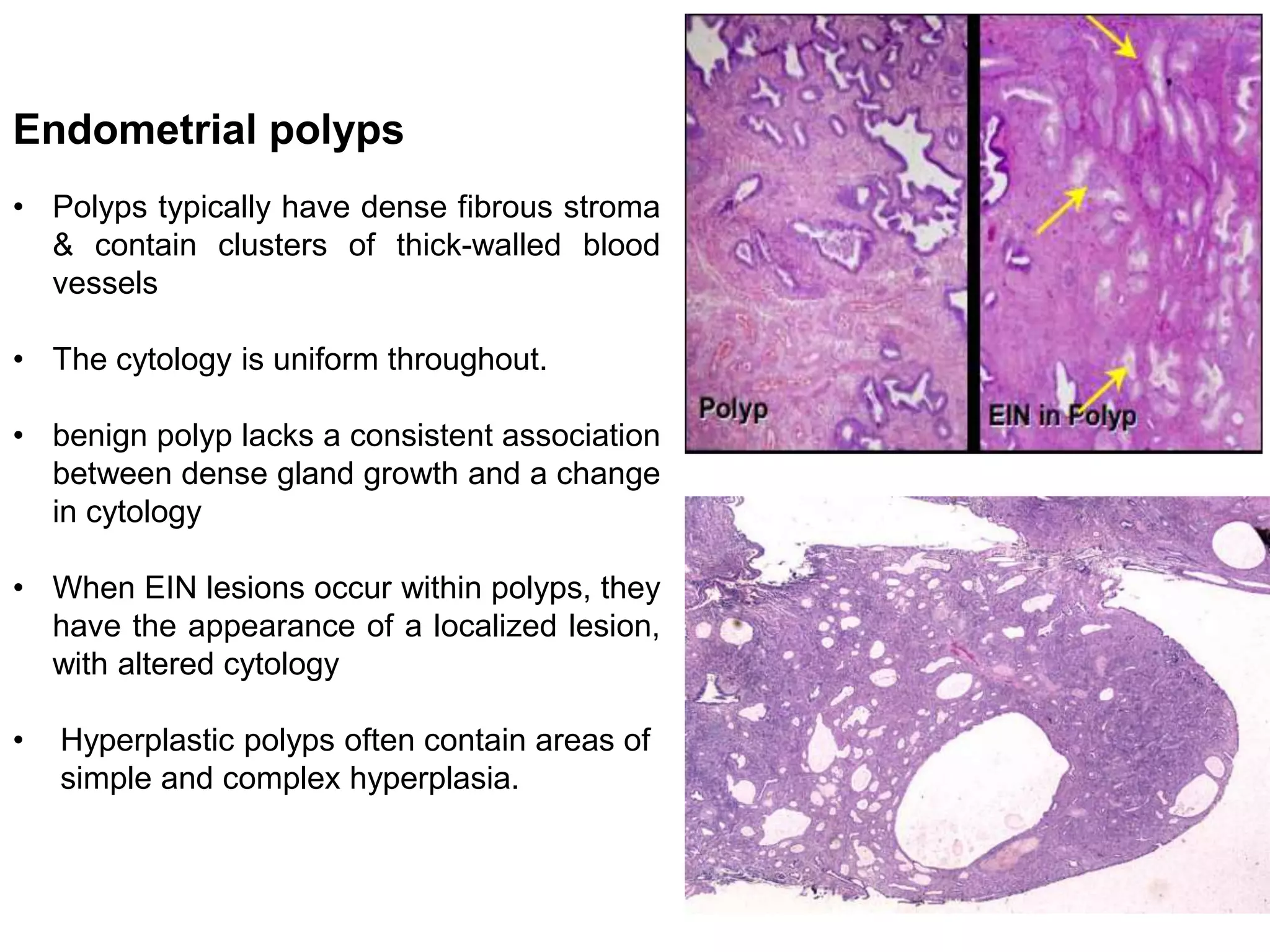 Endometrial hyperplasia | PPTX