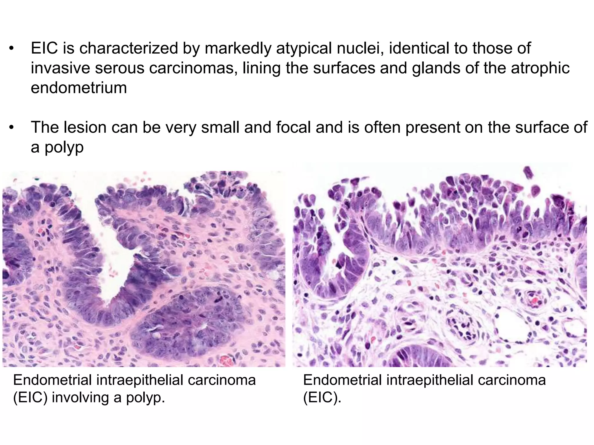 Endometrial hyperplasia | PPTX