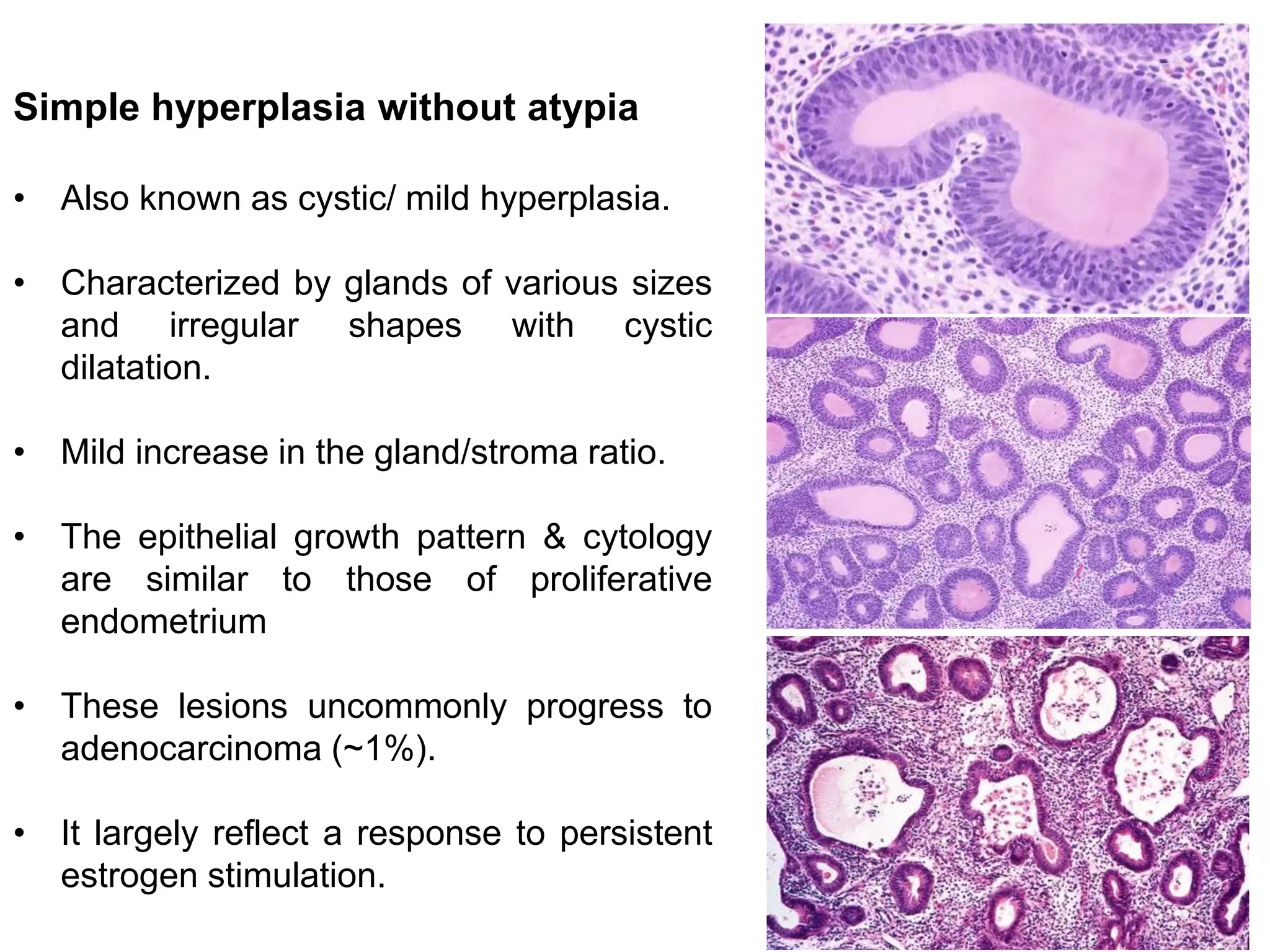 Endometrial hyperplasia | PPTX